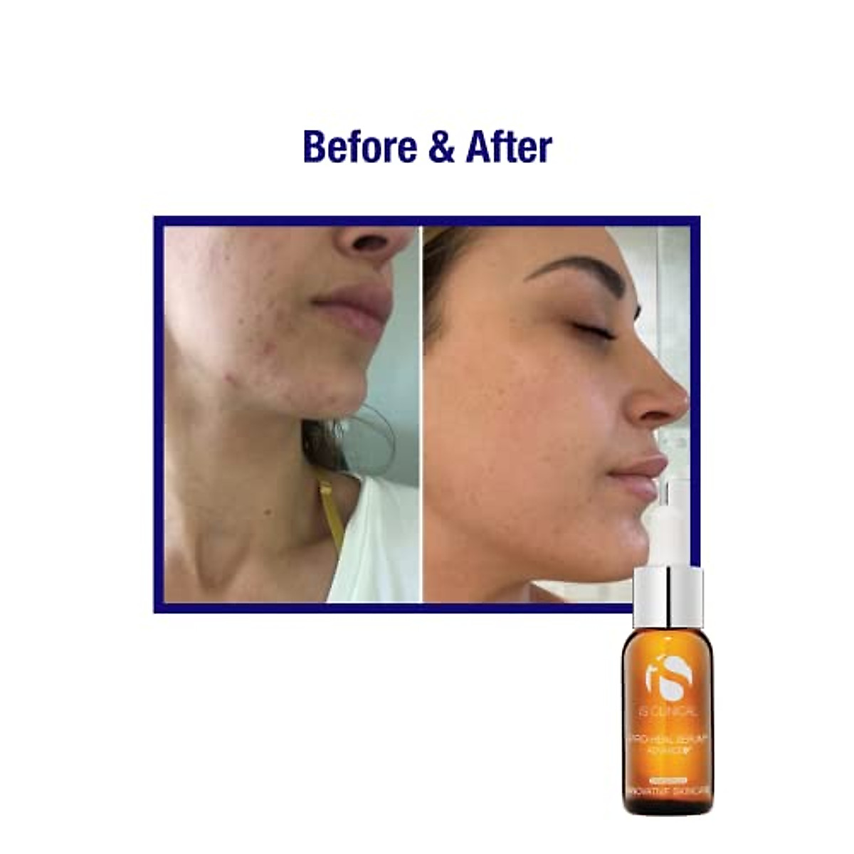 Pro-Heal Serum Advance+ Antioxidant-rich Vitamin C Serum, Vitamin E And Retinol For Redness, Rosacea And Inflammation