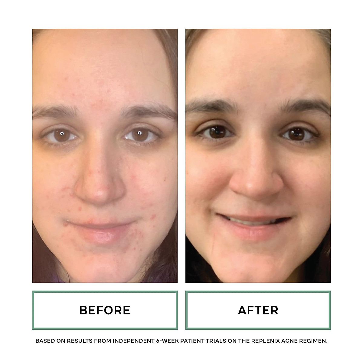 Replenix BP 10% Acne Wash + Aloe Vera, Oil-Free Benzoyl Peroxide Face Cleanser with Medical-Grade Ingredients for Acne-Prone Skin (6.7 fl. oz)