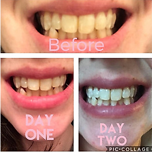 Smile Titan Teeth Whitening Gel Refill 4X Syringes 44% Carbamide Peroxide