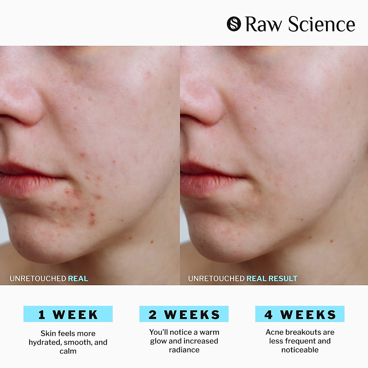 Anti Acne Supplements Cystic Acne Treatment for Teens – Hormonal Acne Pills with Acne Vitamins for Men & Women – clear skin supplement: Vitamin A, Zinc, Niacin Oily Skin & Breakout Control - 60 Caps