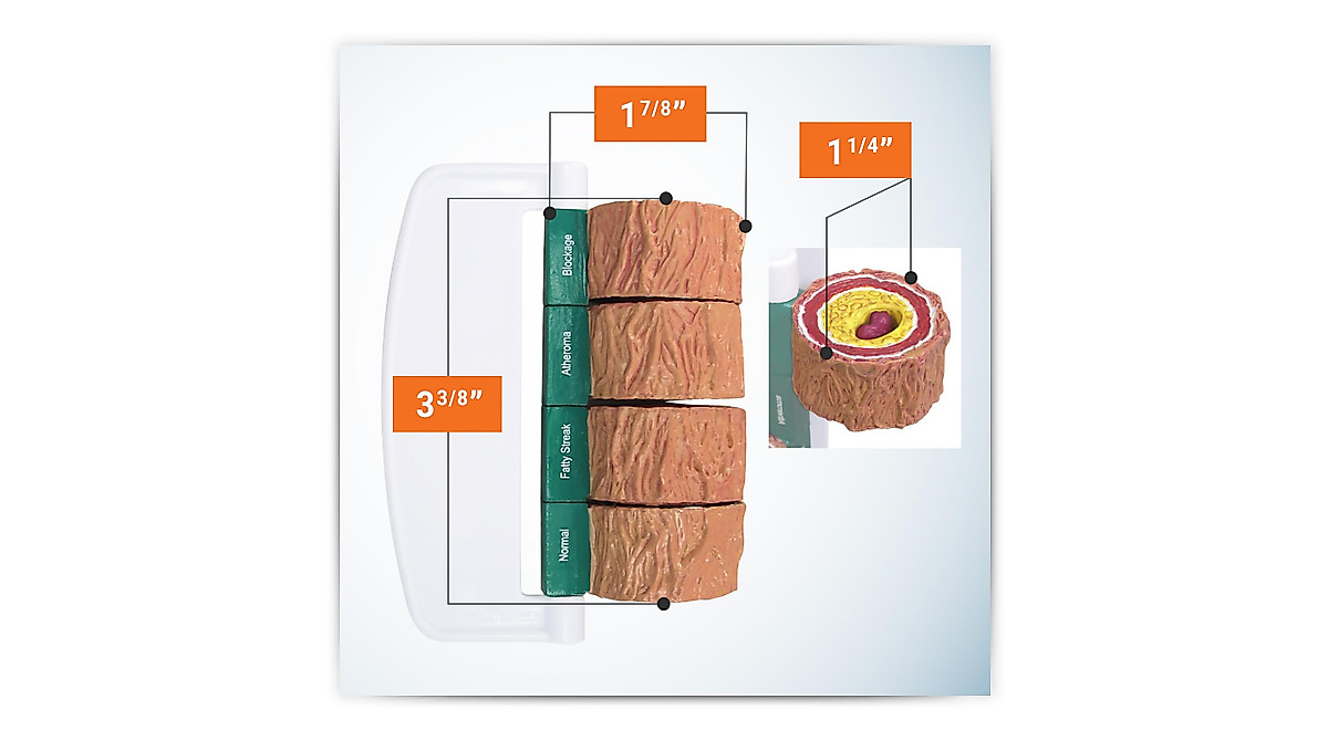 4-Piece Artery Model for Atherosclerosis Education | GPI Anatomicals