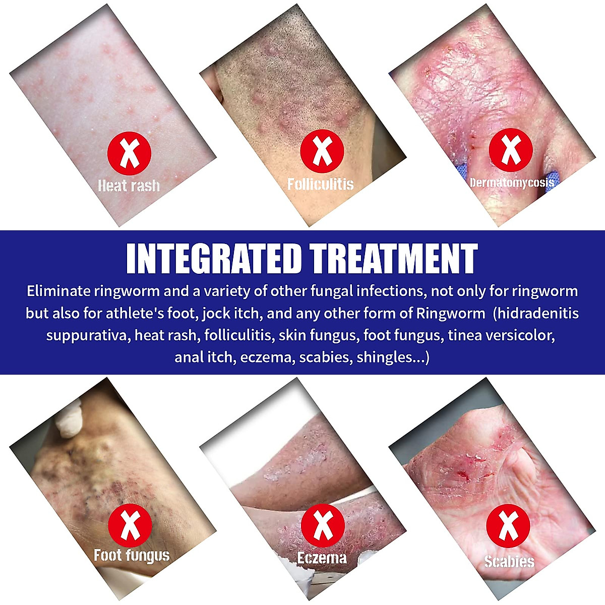 Tea Tree Draw Salve Soothing Cream, Itchy Feet Relief, Jock Itch, Foot Odor, Balls Ringworm, Psoriasis, Eczema, Rash, Dry Cracked Heels, Athlete's Foot, Itching, Burning, Cracking, Scaling Treats