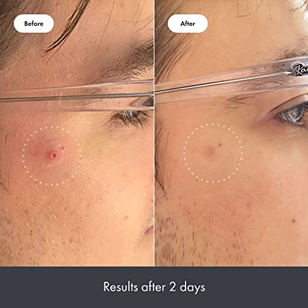 Rescue Balm Post-Blemish Recovery Cream from Hero Cosmetics - Intensive Nourishing and Calming for Dry, Red-Looking Skin After a Blemish - Dermatologist Tested and Vegan-Friendly (50 ml, 1.69 fl. oz)