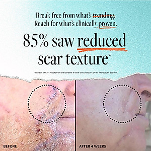 Derma E Scar Gel – Scar Treatment for Face – Hydrating Gel for Acne Scars, Burns & Stretch Marks with Panthenol & Allantoin, 2 oz