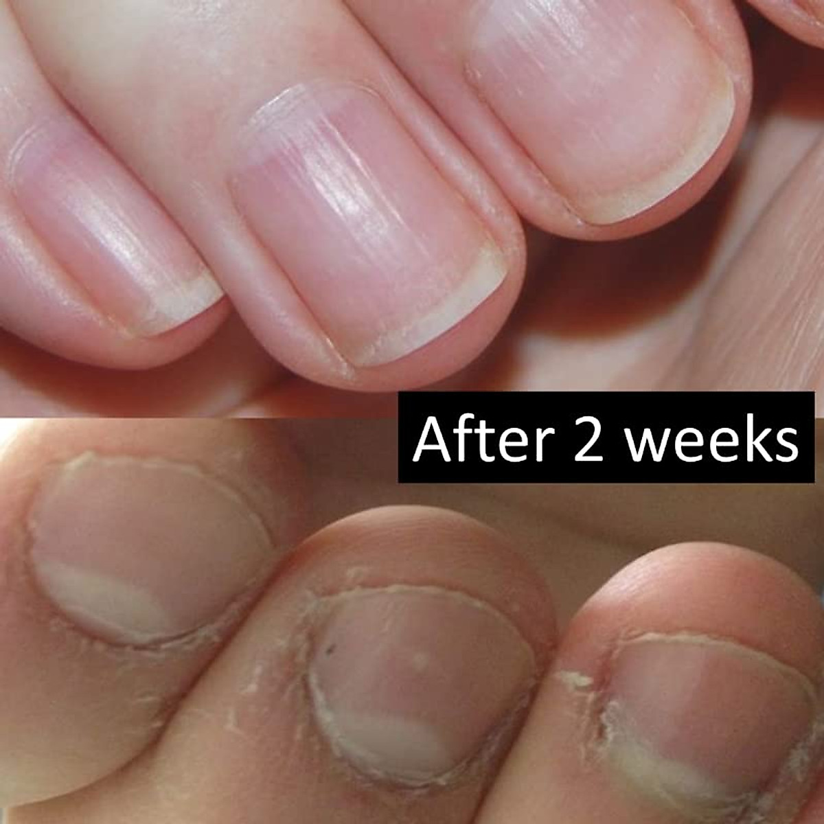 Honest 10 Nail Biting Treatment for Kids and Adults, Strongest Formula, 10-Free of harmful ingredients, Safety Tested, Dries Clear