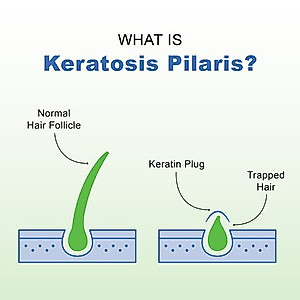 KP Elements Keratosis Pilaris Lotion (4 fl oz) - Natural Keratosis Pilaris Treatment, Moisturizing & Exfoliating AHA Lotion for KP, Vegan, Made in USA