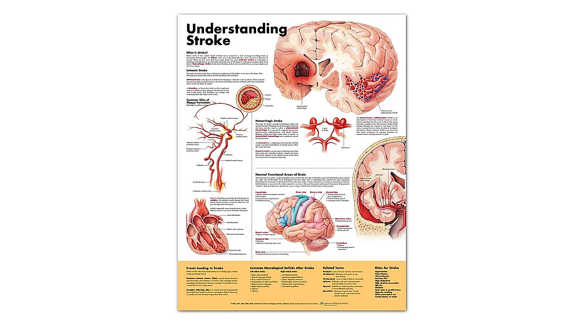 Understanding Stroke Chart - Medical Education & Brain Anatomy