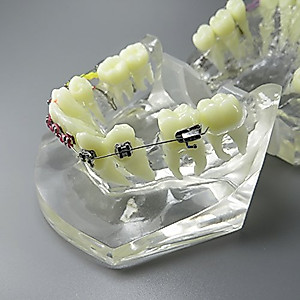 Smile1000 Dental Malocclusion Orthodontic Treatment Teeth Model with Metal Brackets Wires Colorful Ties Chains and Hoops M3005