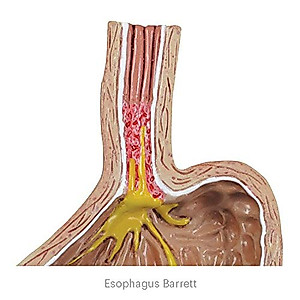 GPI Anatomicals - 4-Piece Stomach Model Set with Gastroesophageal Reflux Disease (GERD), Replica for Human Anatomy and Physiology Education, Anatomy Model for Doctor's Offices, Medical Study Supplies