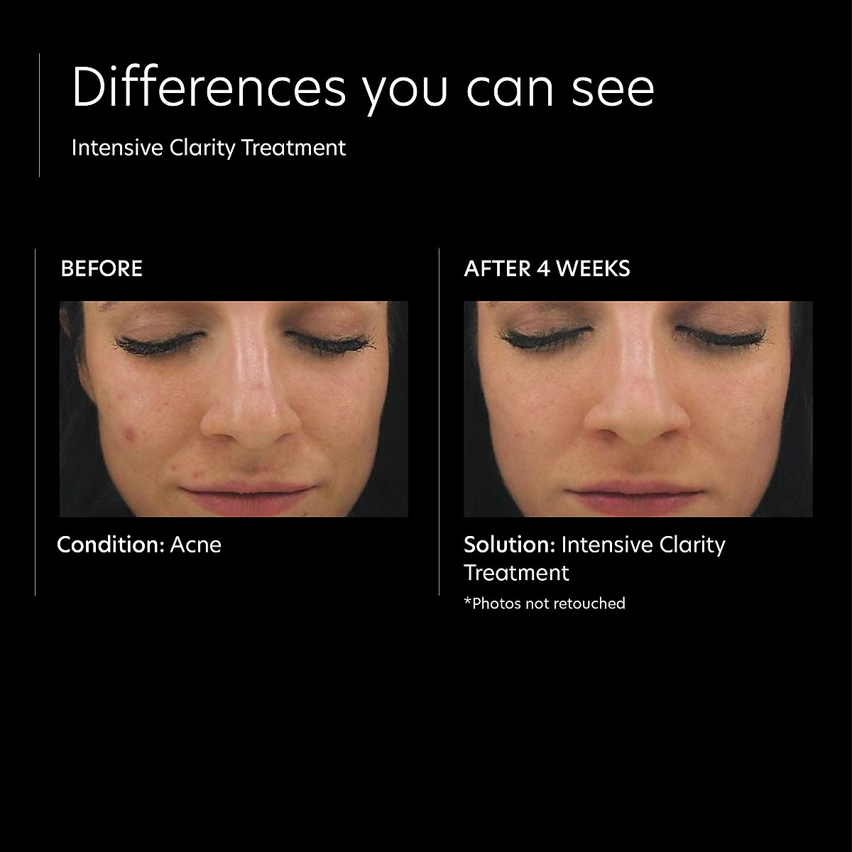 PCA SKIN The Acne Control Skin Care Set (Kit Includes BPO Facial Cleanser, Niacinamide Face Cream, Salicylic Acid Acne Gel, Retinol Treatment)