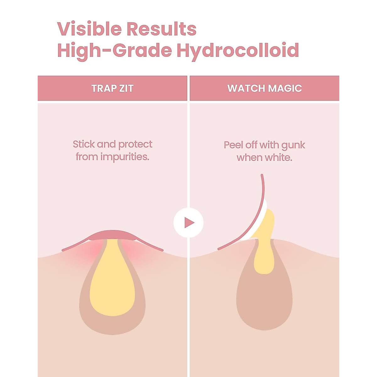 GLAM UP Performance Hydrocolloid Blemish Pimple Zit Patches - Ultra Thin Invisible Spot Cover Patches for Face and Skin, Strong Water-proof and Adhesive Overnight, Vegan-friendly (108 Count / 2Sizes)