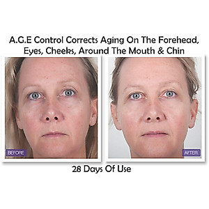 AGE Control Dual Treatment Anti Glycation Serum: Look 8-10 Years Younger In 60 Days. Reduce Discoloration & Dark Spots, Lifting, Firming, Brightening, Hydrating, Anti-Wrinkle, Non Greasy