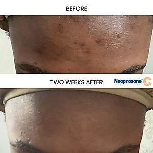 Neoprosone, Vitamin C Serum for Face | 1 Fl oz / 30ml | Brightening Serum For Dark Circle, Wrinkles | with Alpha Arbutin and Castor Oil