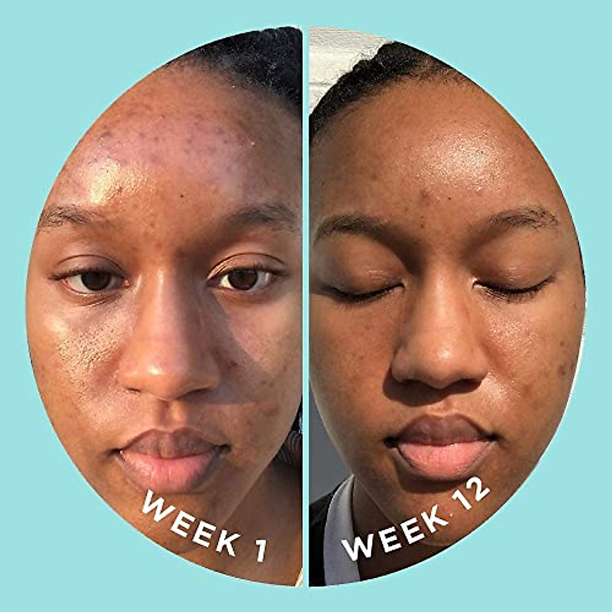 ZitSticka Vitamin Acne Supplement for Cystic Acne w/ 30 Natural Caps for Women and Men, Supplements for Hormonal Support, Skin Clarity, Dark Spots - Dermatologist Tested (Blur Potion™)