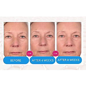 Serious Skincare - Dr. Mark Pinsky - Trace + Erase Needle Free Wrinkle Filler - Fills Visible Deep Lines, Wrinkles and Creases - Helps Restore Skin's Elasticity and Tone - Face and Neck 1 Fl Oz