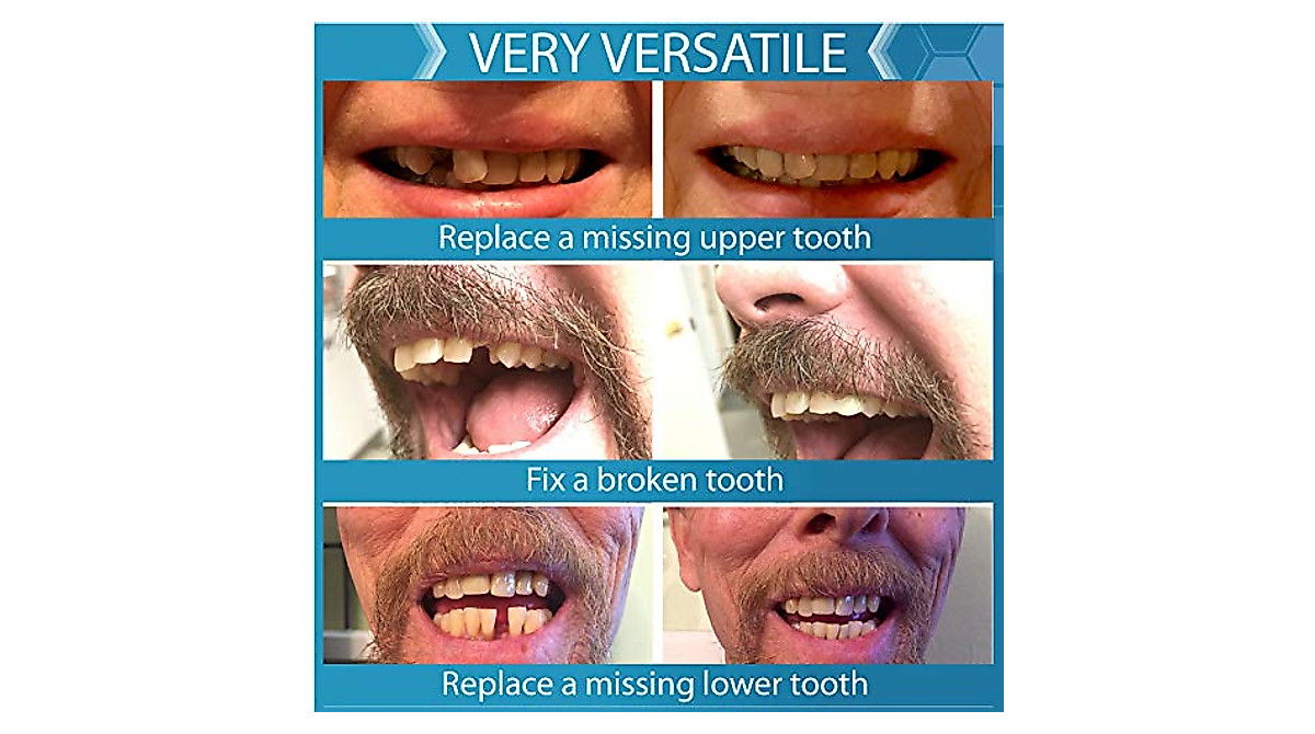 Complete Your Smile Tooth Replacement Kit DELUXE Pack - Easy At-Home ...
