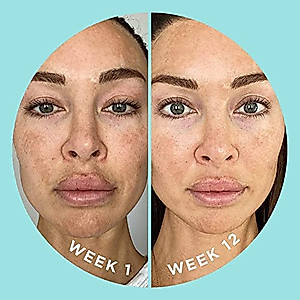 ZitSticka Vitamin Acne Supplement for Cystic Acne w/ 30 Natural Caps for Women and Men, Supplements for Hormonal Support, Skin Clarity, Dark Spots - Dermatologist Tested (Blur Potion™)