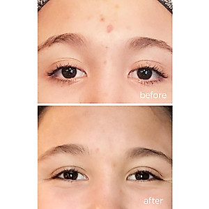 Perricone MD Acne Relief Maximum Strength Spot Gel, 0.5 fl. oz.