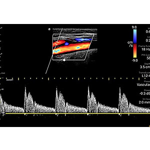 Philips FUS6882 Lumify L12-4 Linear Array Transducer, Portable Ultrasound Solution