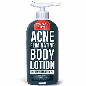 TreeActiv Acne Eliminating Body Lotion, 8 fl oz, Salicylic Acid Lotion, Salicylic Acid Body Acne Treatment, Back Acne Treatment Cream for Women and Men, Acne Lotion for Body, Zit Cream with 2000+ Uses