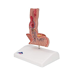3B Scientific K18 Illnesses of the Esophagus - 3B Smart Anatomy