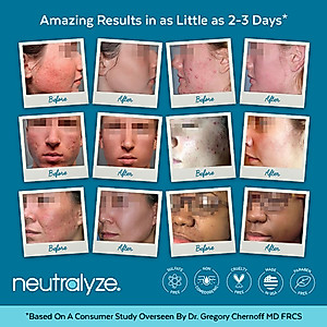 Neutralyze Maximum Strength Acne Moisturizer for Face & Body - Time Released, Medical Grade 2% Mandelic Acid & Salicylic Acid Cream - Renewal Complex Facial Moisturizer for Acne Prone Skin (90+ Day)