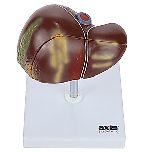 Axis Scientific Anatomy Model of Diseased Liver | Model is 1/3 Life-Size and Divides in 2 Parts | Shows 6 Liver Diseases and Abnormalities | Comes on a White Base