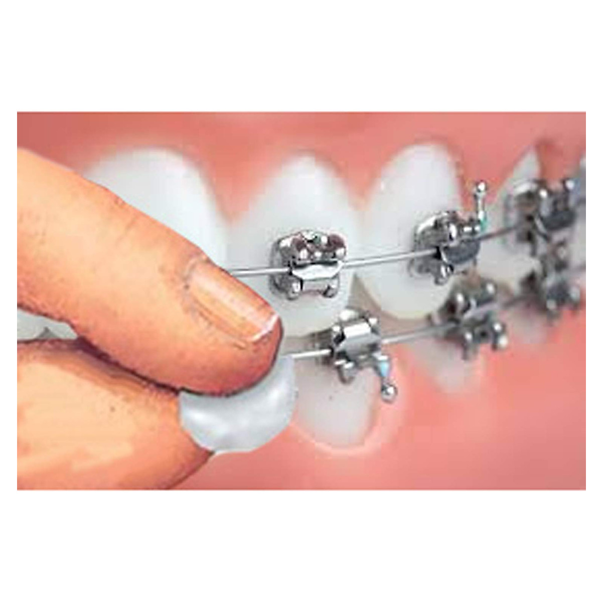 Genuine Orthowax - Orthodontic Wax for Braces Wearer - Stick Better Than competitors