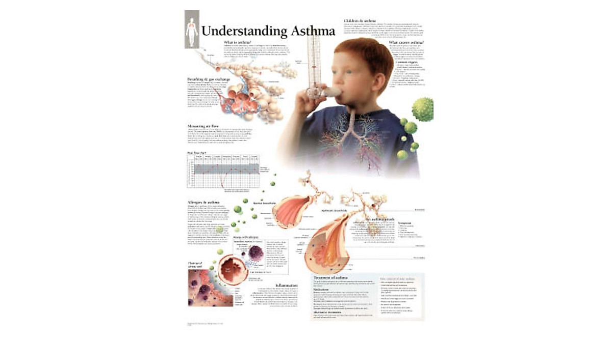 Understanding Asthma Wall Chart - Laminated Educational Poster