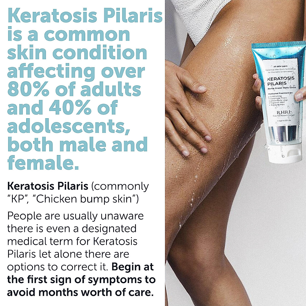 KP Bump Eraser Body Scrub, Keratosis Pilaris Treatment, Strawberry Legs Treatment for Women, Bump Eraser Body Scrub, Keratosis Pilaris, Body Scrub for Strawberry Legs