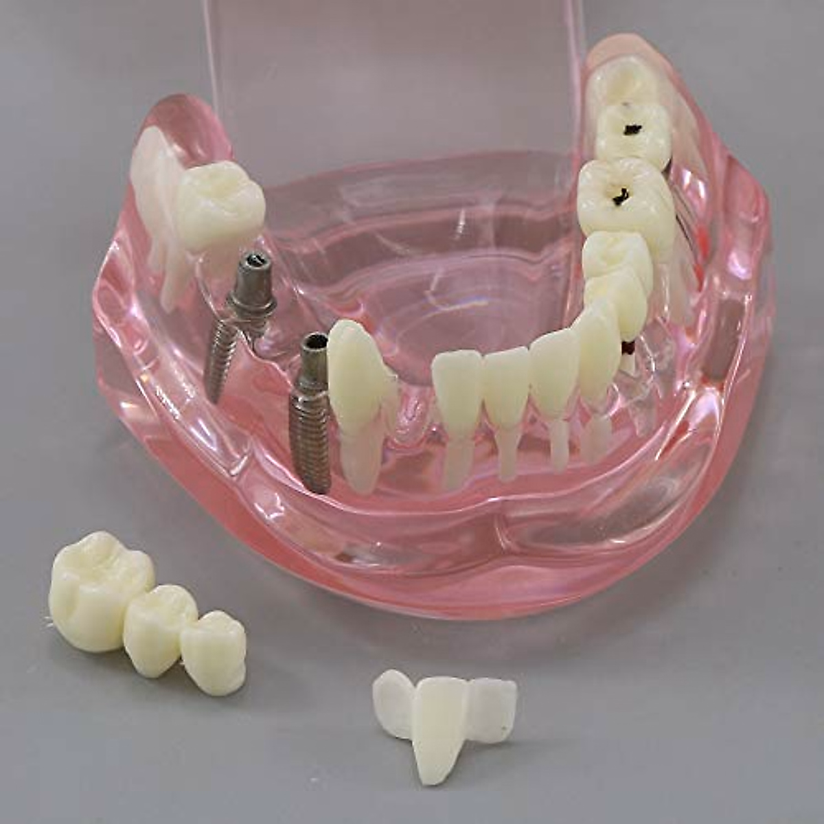 Dentalmall Teeth Model Teeth Typodonts Dental Implant Study Analysis Demonstration Teeth Model #2001 with Restoration Pink
