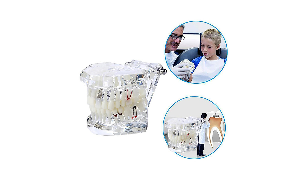 Dentalmall Implant Typodont Model for Education