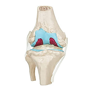 Spancare 4 Stage Osteoarthritis Anatomical Knee Model, Model On Base, with Detailed Study