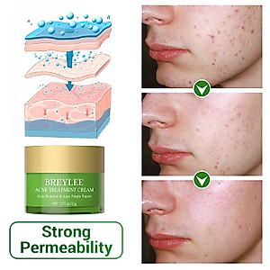 BREYLEE Acne Treatment Cream, Tea Tree Oil Acne Cream for Clearing Severe Acne, Breakout, Remove Pimple and Repair Skin (20ml,0.7oz)