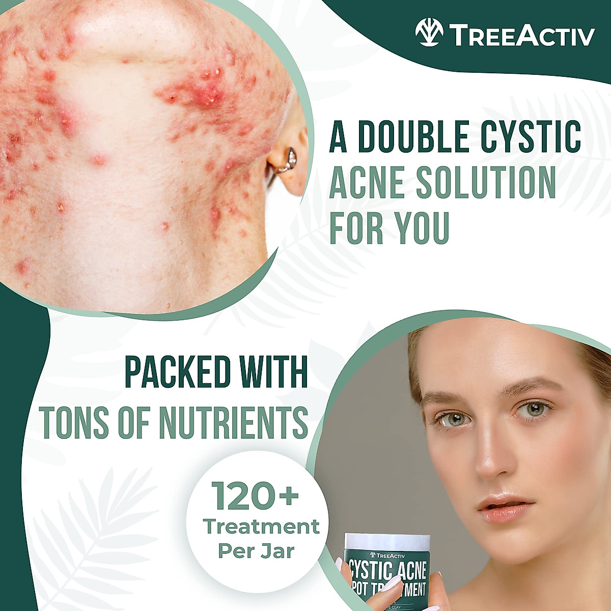 TreeActiv Cystic Acne Spot Treatment, 2-Pack, Sulfur Spot Treatment, Hormonal Acne Treatment with Tea Tree, Cystic Acne, Blackheads, Cystic Acne Treatment and Pimple Spot Treatment for Face, 240+ Uses