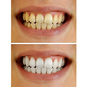 Teeth Whitening Gel Syringe Dispensers 22% Carbamide Peroxide, 10 Tooth Bleaching Gel 3ml Syringes