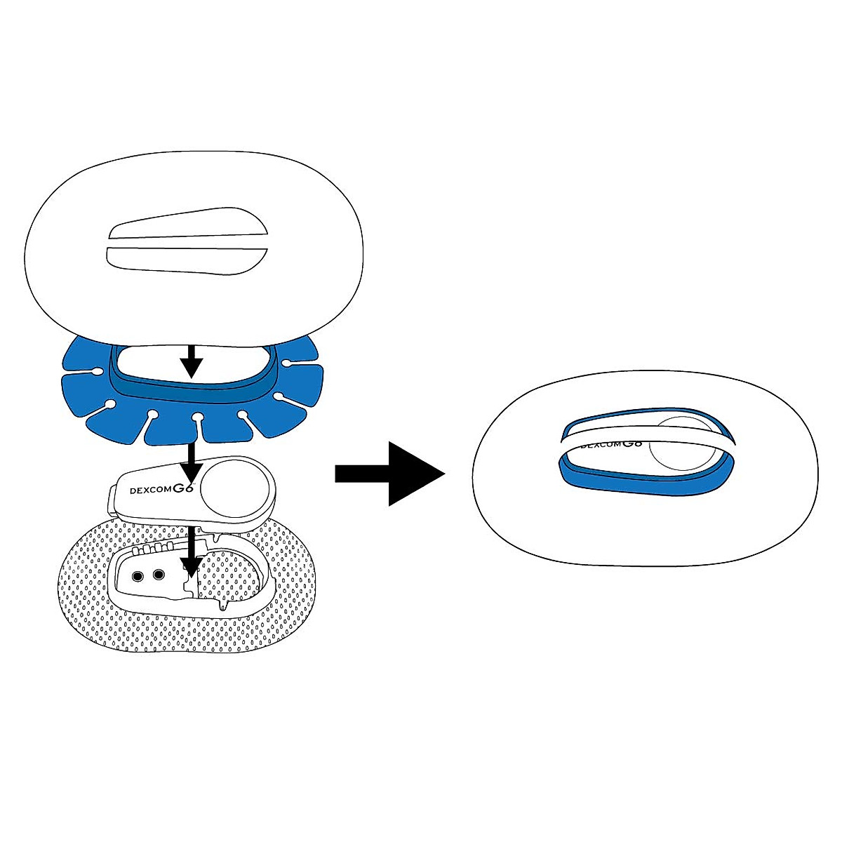 The Blue G6 Shield for Your Dexcom Over Patches Diabetic Accessory | Reusable and Washable | Great Gift for a Diabetic Child or Adult