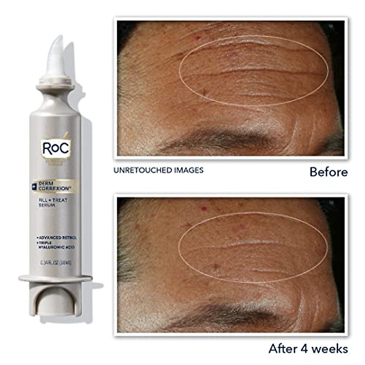 RoC Derm Correxion Fill + Treat Advanced Retinol Serum, Wrinkle Filler Treatment with Hyaluronic Acid for Forehead Wrinkles, Crow's Feet, Eleven Wrinkles, and Laugh Lines, 15ml