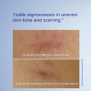 iS CLINICAL Super Serum Advance+, Anti-Aging Vitamin C Face Serum, reduces scaring and fine stretch marks, 1 Fl Oz