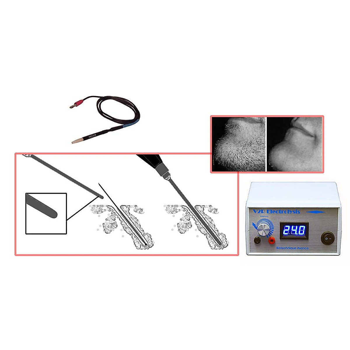 V2R Electrolysis System for Permanent Hair Removal with Accessory Kit.