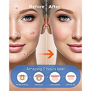 LitBear Acne Pimple Patches- Day and Night 4 Sizes 180 Dots Thin & Thick Hydrocolloid Patches with Witch Hazel, Tea Tree & Calendula Oil, Extra Adhesion Pimple Patches for Face Zit Patch Acne Dots