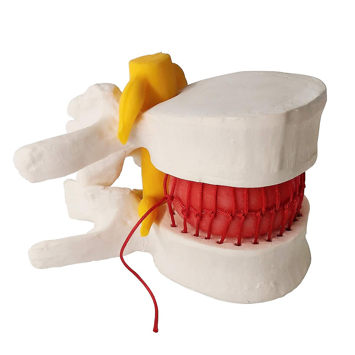 Human Herniated Disc Model, Anatomical Herniated Lumbar Vertebrae Disc Prolapse Model for Medical Teaching Learning, Kids Learning Education Display Toolning, Kids Learning Education Display Tool