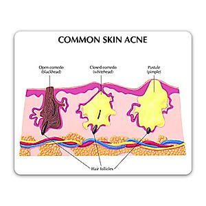 GPI Anatomicals - Skin Acne Model, Cylindrical Model Showing Normal and Common Acne-Riddled Skin for Human Anatomy and Physiology Education, Anatomy Model for Doctor's Office, Medical Study Supplies