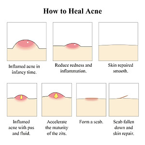 Acne Treatment Serum, BREYLEE Tea Tree Clear Skin Serum for Clearing Severe Acne, Breakout, Remover Pimple and Repair Skin (17ml,0.6oz)