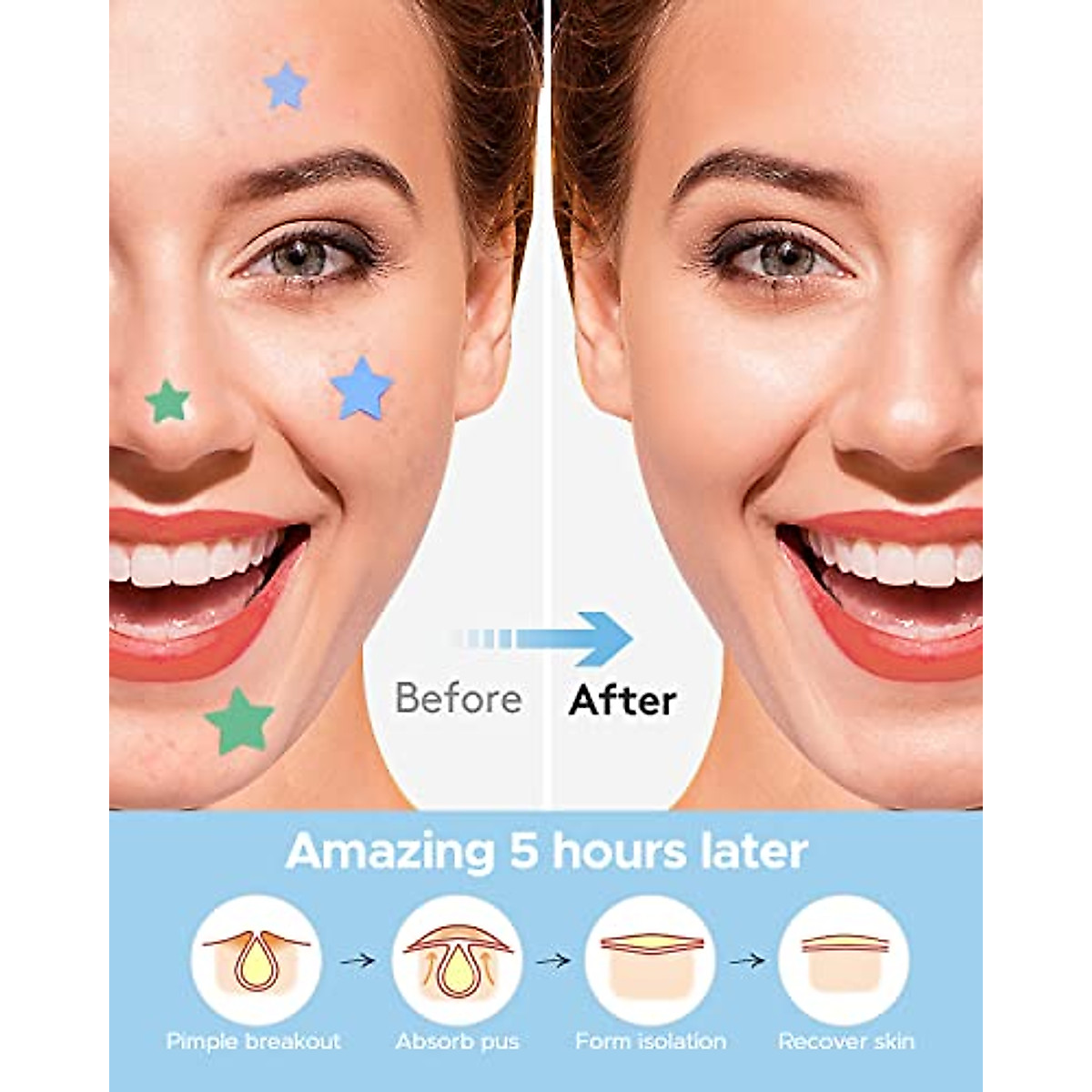 LitBaer Star-Shaped Pimple Patch Hydrocolloid Acne Stickers with Tea Tree Oil + Salicylic Acid, Cover Dot for Acne Blemish, Pimples, Whiteheads, Zit, Draw out Oil & Impurities, 112 Dots, 14mm & 10mm