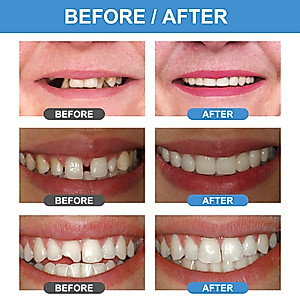 Tooth Repair Kit, Fake Teeth for Temporary Fixing The Missing and Broken Tooth Replacements