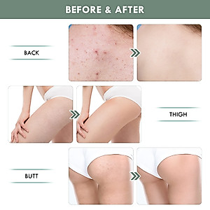 Butt Acne Clearing Treatment, Bum Acne Treatment Butt Pimple Cream Clears Pimples For the Buttocks, Back and Thigh Areas with Salicylic Acid, Pure Natural Ingredients and Fast Results