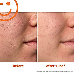 Kate Somerville ExfoliKate Intensive Exfoliating Treatment – Salicylic Acid and Lactic Acid Super Facial Scrub Improves Texture and Pores, 0.5 Fl Oz