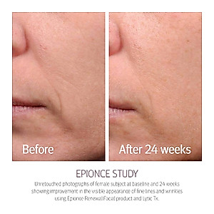 Epionce Renewal Facial Lotion - Hydrating, Anti-Aging Moisturizer for Normal to Combination Skin, For Fine Lines & Wrinkles, Dermatologist Skincare