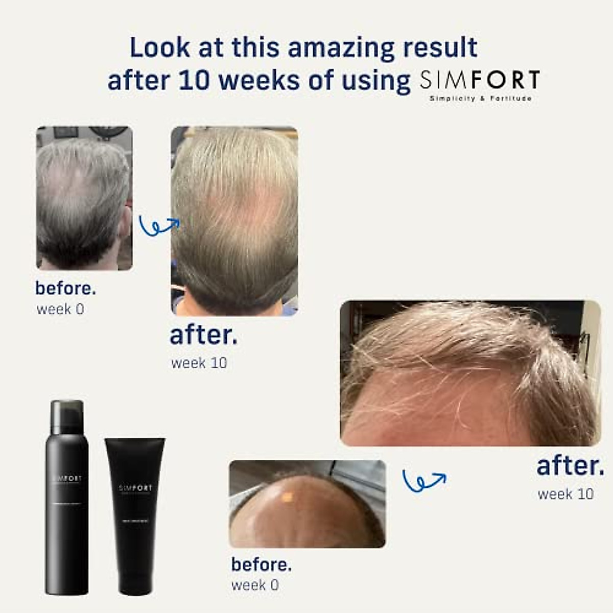 SIMFORT SPARKLING SCALP SHAMPOO for Thinning Hair and Hair Loss - Hair Growth Treatment (2 Pack)